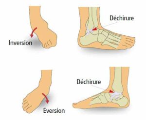Le louedec | Entorse de cheville