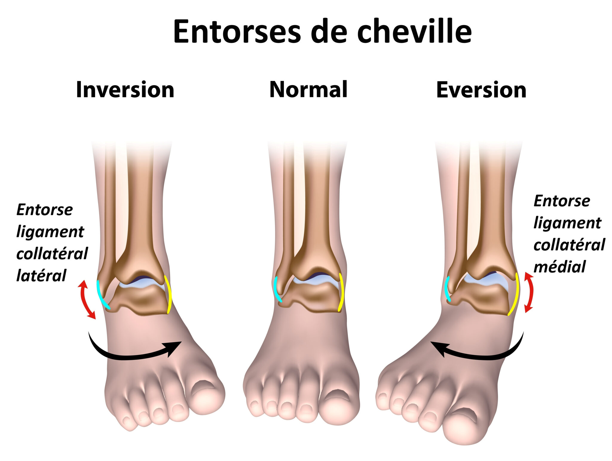 Le louedec | Instabilité de cheville